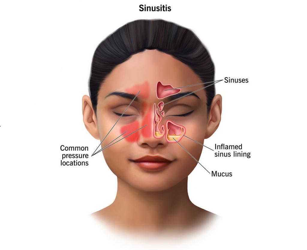 Chronic Sinusitis - Pinnacle Vitality Rehab